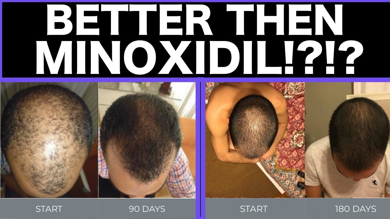 Comparing the Best Brands of Minoxidil: Key Differences Explained ...